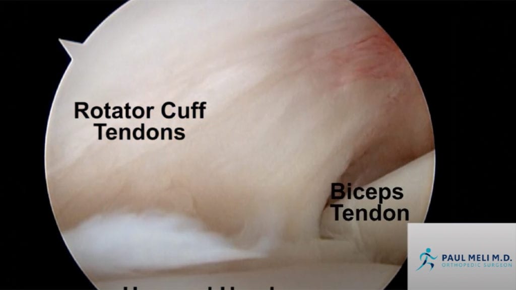 Orthopedic Surgery Video Gallery | Paul Meli Orthopedic Surgeon