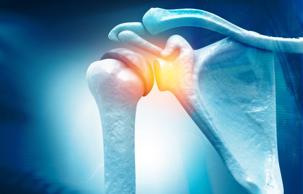 Recognizing the Signs of Rotator Cuff Tear - Paul Meli Orthopedics